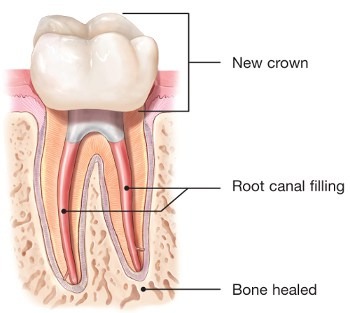 Root Canal Cap