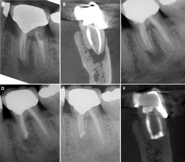 Is Retreatment Always Necessary Before Endodontic Surgery? - American ...