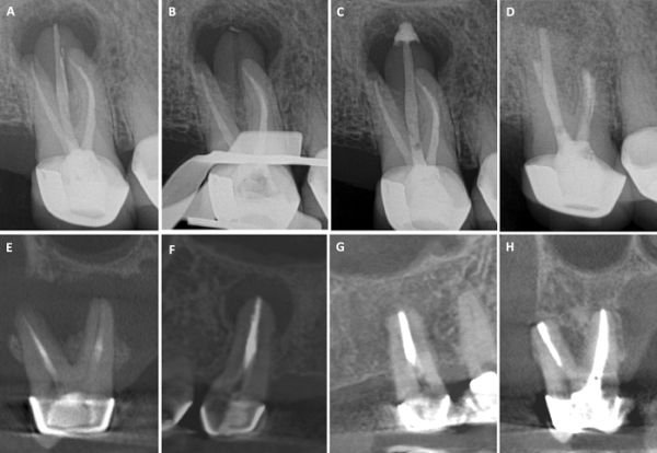 Is Retreatment Always Necessary Before Endodontic Surgery? - American ...