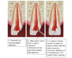 Traumatic Pulp Exposures: A Quick Review - American Association of ...