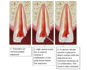 Traumatic Pulp Exposures: A Quick Review - American Association of ...
