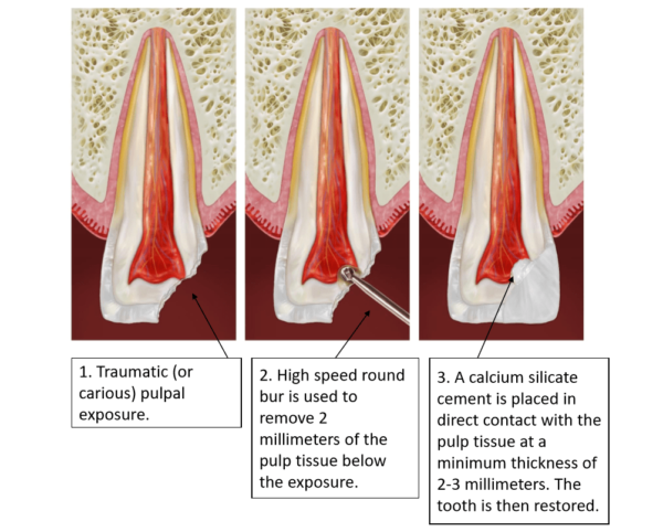 Traumatic Pulp Exposures: A Quick Review - American Association of ...
