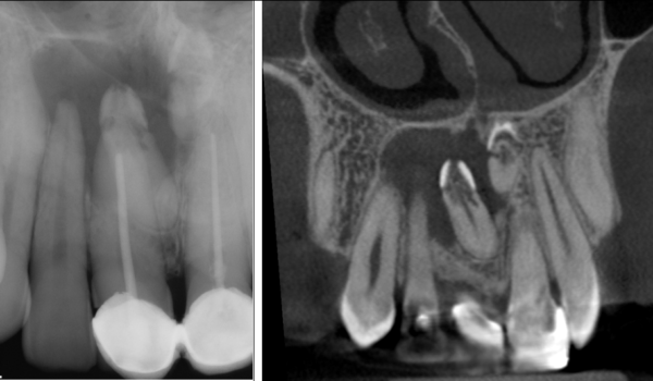 External Invasive Resorption: Conceptions and Misconceptions - American ...