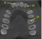 External Invasive Resorption: Conceptions and Misconceptions - American ...