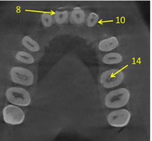 External Invasive Resorption: Conceptions and Misconceptions - American ...