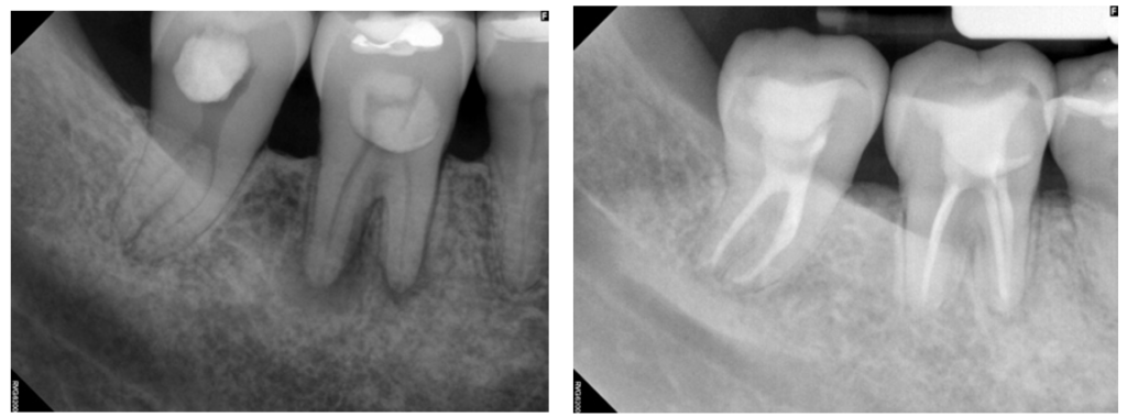 Treating Patients with Disabilities - An Endodontic Perspective ...