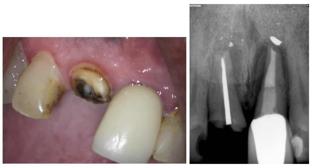 Treating Patients with Disabilities - An Endodontic Perspective ...