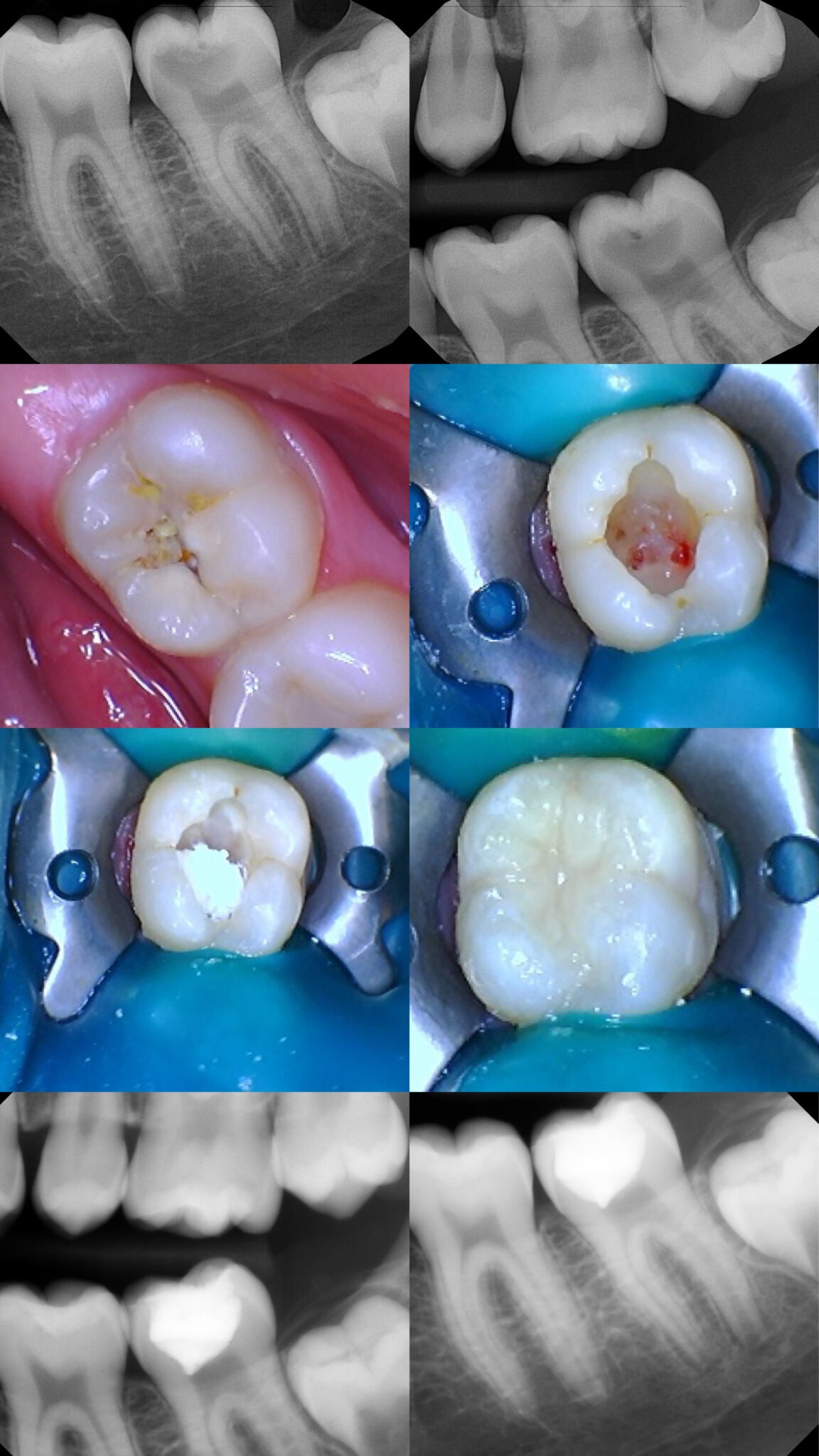 Management of Deep Caries for Immature Teeth: A Philosophical Dilemma ...