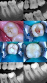 Management of Deep Caries for Immature Teeth: A Philosophical Dilemma ...
