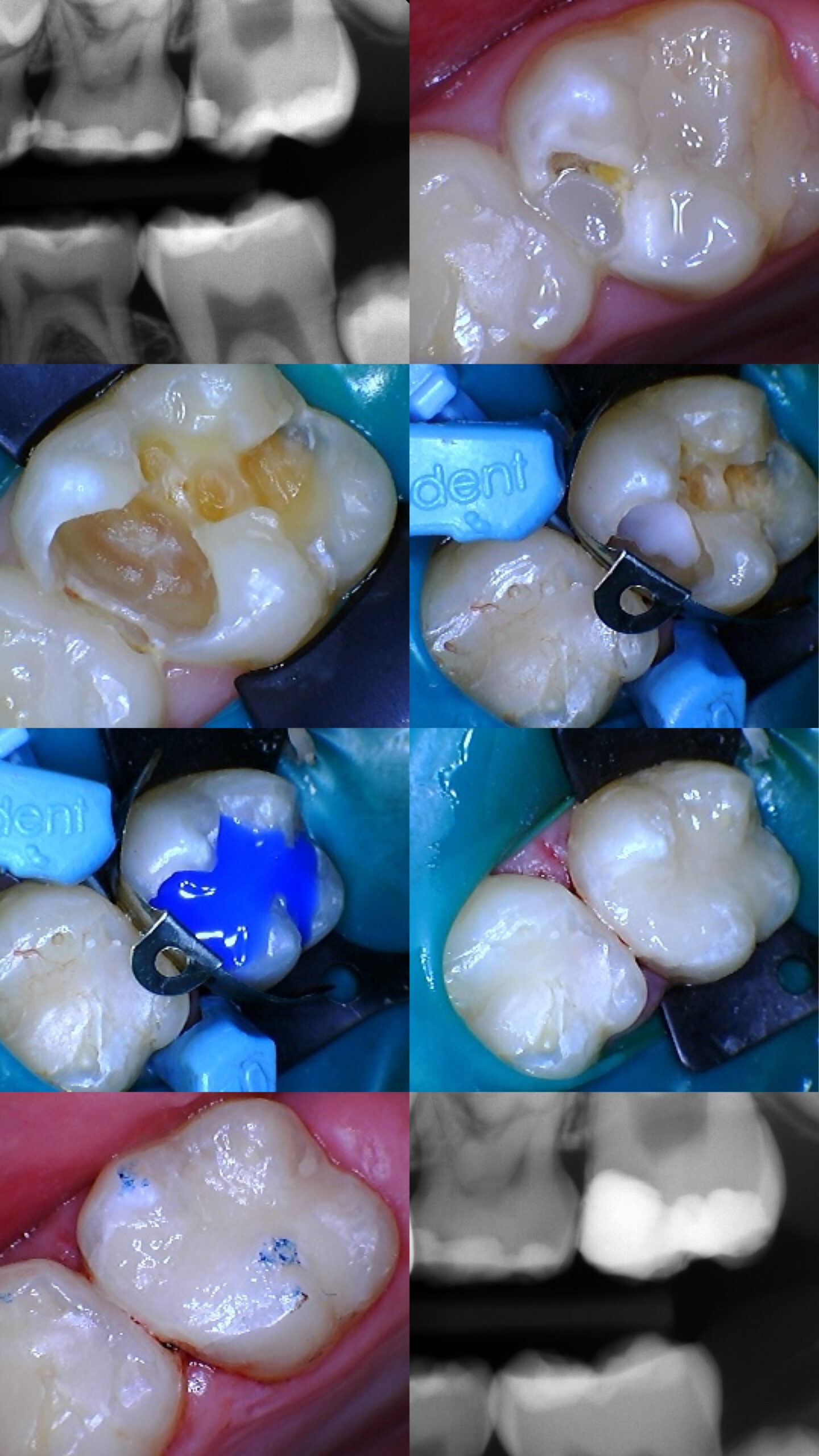 Management of Deep Caries for Immature Teeth: A Philosophical Dilemma ...