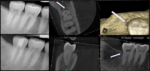 Cracked Teeth: To Treat or Not to Treat? - American Association of Endodontists