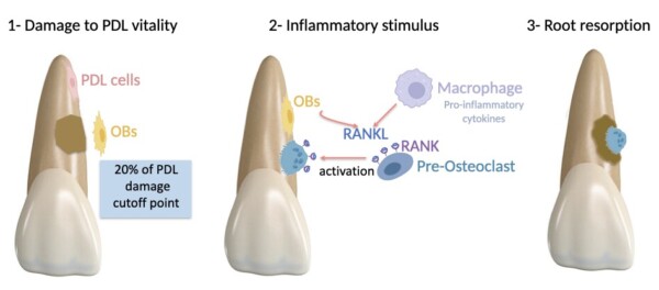 Cell-Based PDL Regeneration for the Management of Avulsed Teeth ...