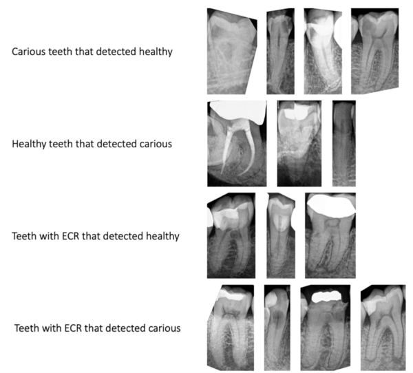 Embracing AI in Endodontics: Pioneering Detection of External Cervical ...
