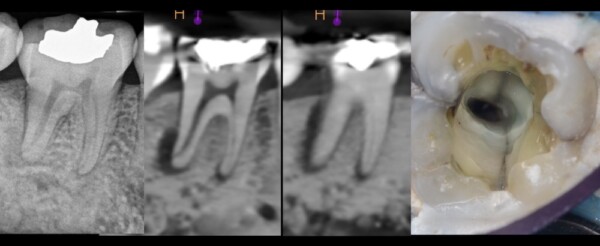 Endodontic Periodontic Lesions - American Association of Endodontists