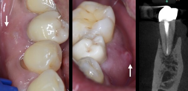 Endodontic Periodontic Lesions - American Association of Endodontists