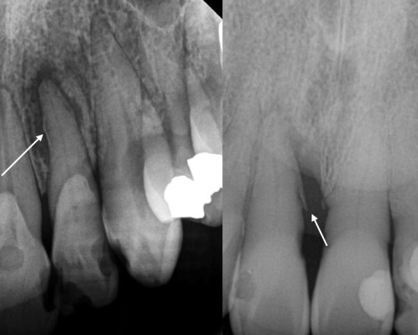 Endodontic Periodontic Lesions - American Association of Endodontists