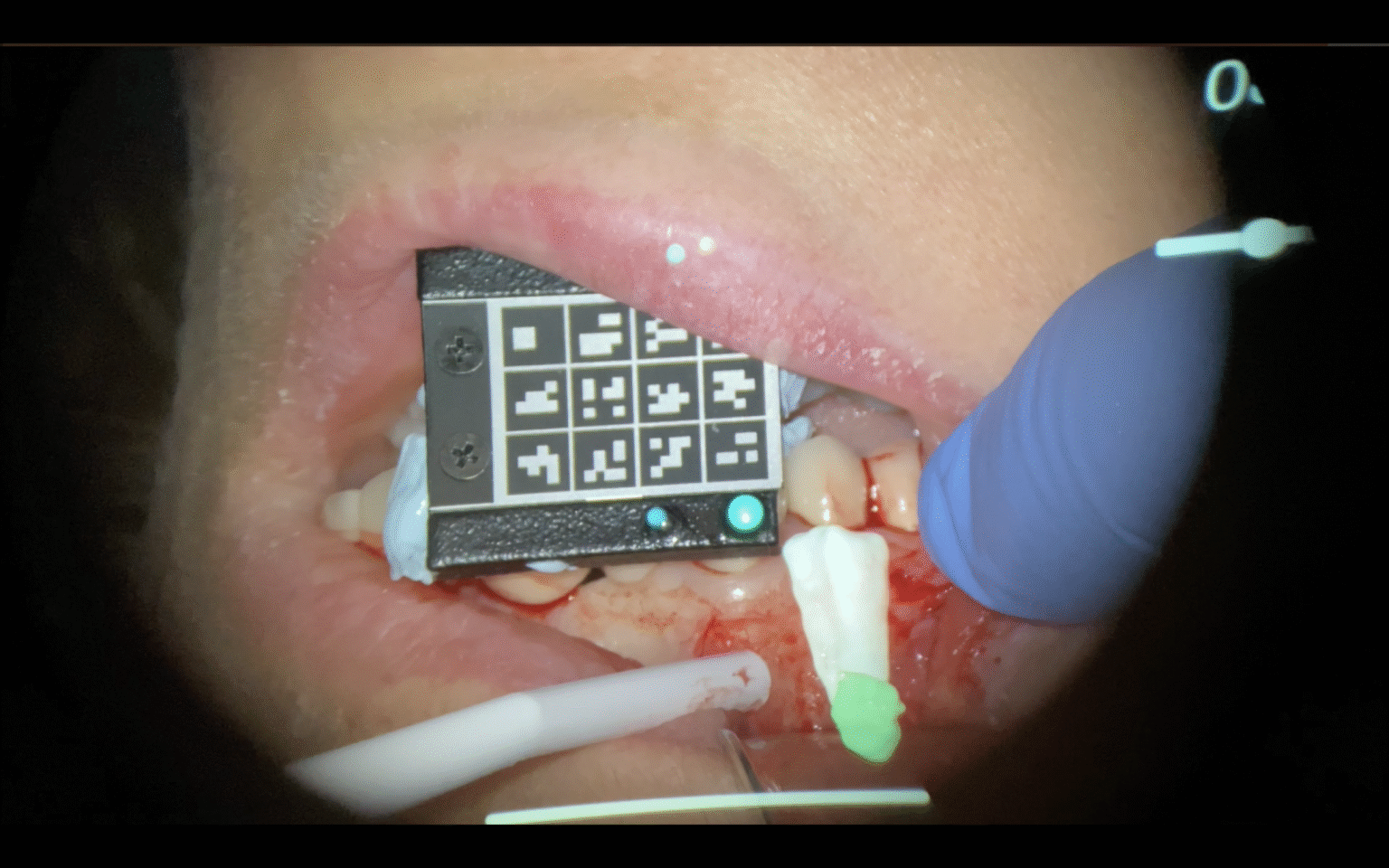 3D Model Guided Endodontics: A New Technique Utilizing Augmented ...